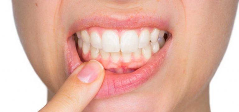 Perchè compare l'afta orale? | Studio Dentistico Sante Vassallo
