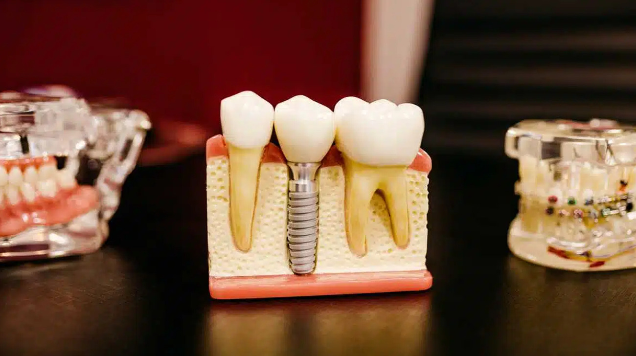 Implantologia flapless: l'approccio innovativo senza necessità di ...