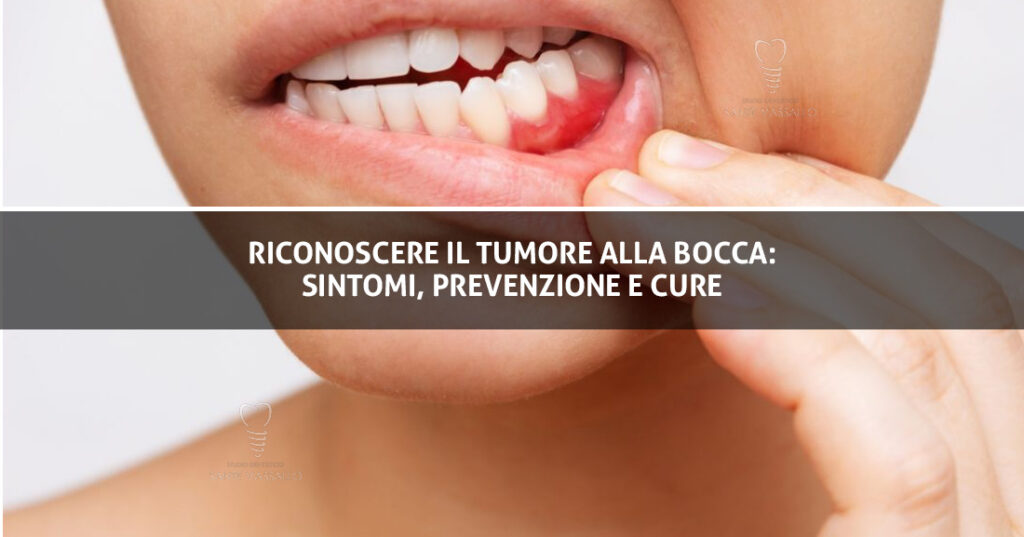 Riconoscere il Tumore alla Bocca: Sintomi, Prevenzione e Cure | Studio ... Riconoscere il Tumore alla Bocca: Sintomi, Prevenzione e Cure | Studio ...
